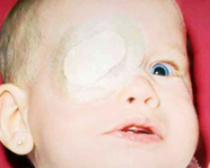 Amblyopia - Pediatric Ophthalmic Consultants
