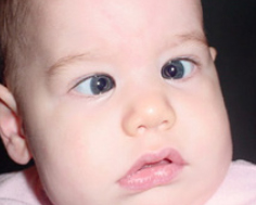Esotropia (Crossed Eyes) - Pediatric Ophthalmic Consultants