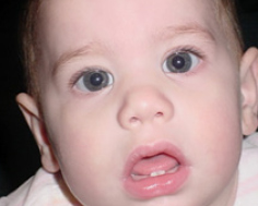 Esotropia (Crossed Eyes) - Pediatric Ophthalmic Consultants