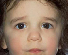 Exotropia - Pediatric Ophthalmic Consultants