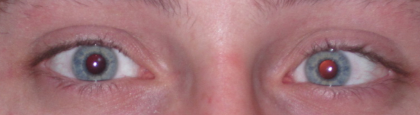 Adult Strabismus - Pediatric Ophthalmic Consultants