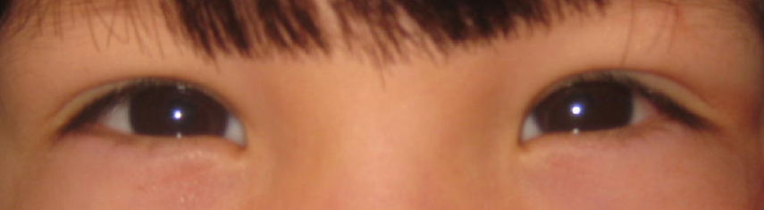 Complex Strabismus & Syndromes - Pediatric Ophthalmic Consultants