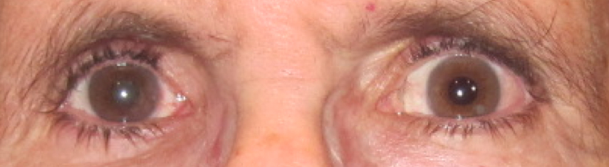 Complex Strabismus & Syndromes - Pediatric Ophthalmic Consultants