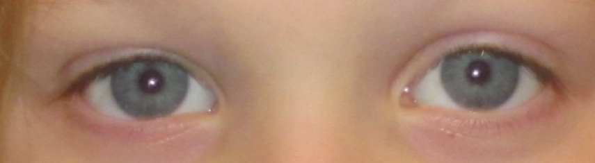 Exotropia - Pediatric Ophthalmic Consultants