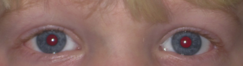 Exotropia Eyes Memes