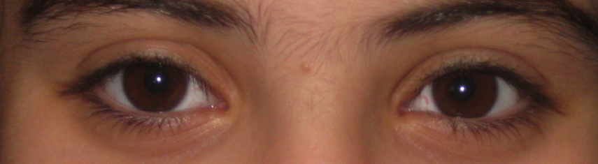 Exotropia - Pediatric Ophthalmic Consultants