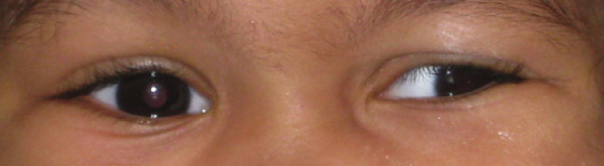 Exotropia - Pediatric Ophthalmic Consultants