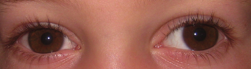 Exotropia - Pediatric Ophthalmic Consultants