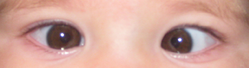 Esotropia (Crossed Eyes) - Pediatric Ophthalmic Consultants
