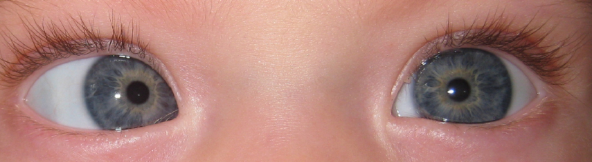 Esotropia (Crossed Eyes) - Pediatric Ophthalmic Consultants