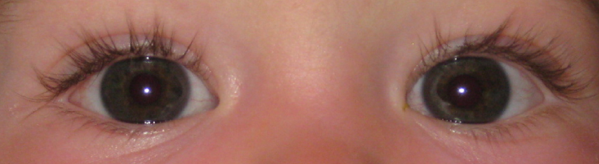 Esotropia (Crossed Eyes) - Pediatric Ophthalmic Consultants